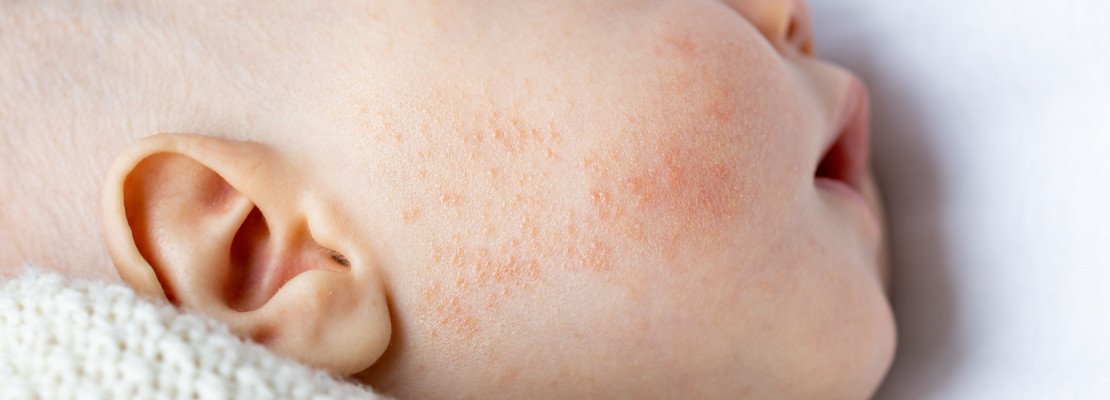 Neugeborenenakne: Wie die kleinen Pickel entstehen